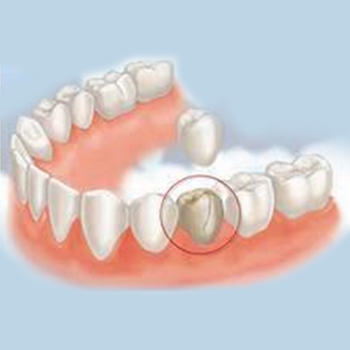 Missing Tooth? What Are Your Replacement Options? | Lygon Family Dental